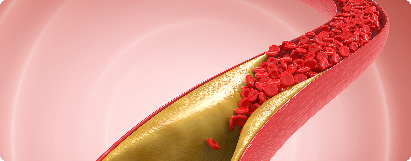 What Causes Heart Disease? (The Truth About Cholesterol)