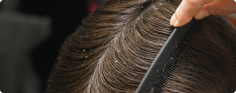 Say Goodbye To Dandruff: 8+ Tips For Natural Improvement